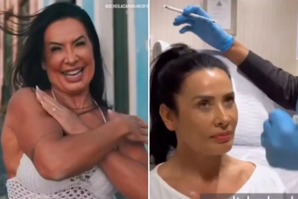 Scheila Carvalho remove procedimento estético do rosto; antes e depois