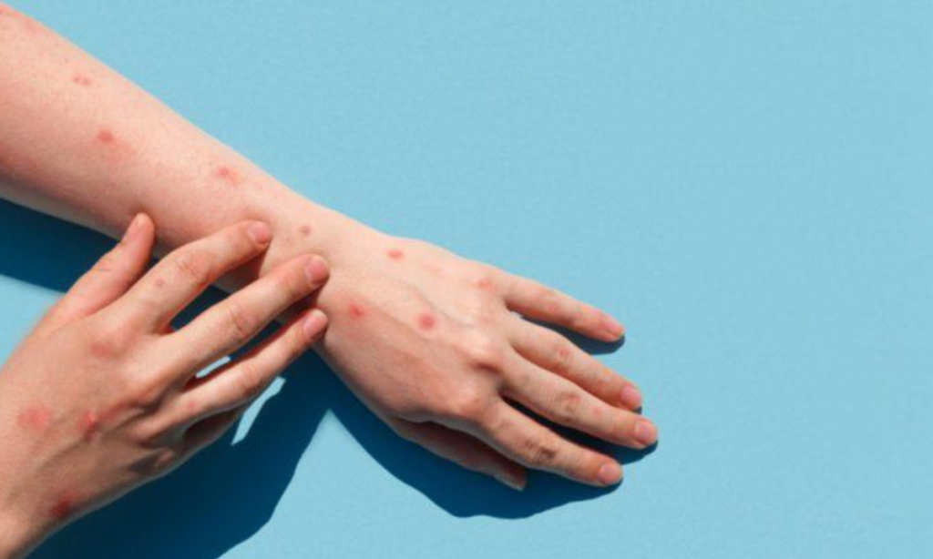 Varíola dos macacos: dermatologistas alertam para risco de confundir ...