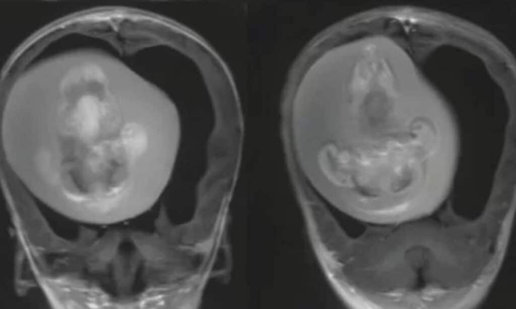 Menina passa por cirurgia para retirar feto de irmão gêmeo do crânio